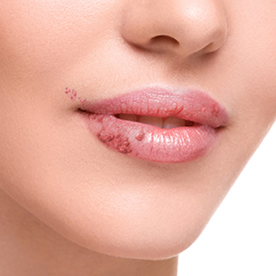 Cold Sores | Schweiger Dermatology Group