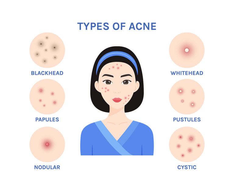 Combating Acne Head On | Schweiger Dermatology Group