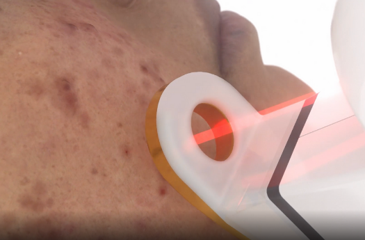 AviClear Acne Laser Treatment | Before & After Pictures