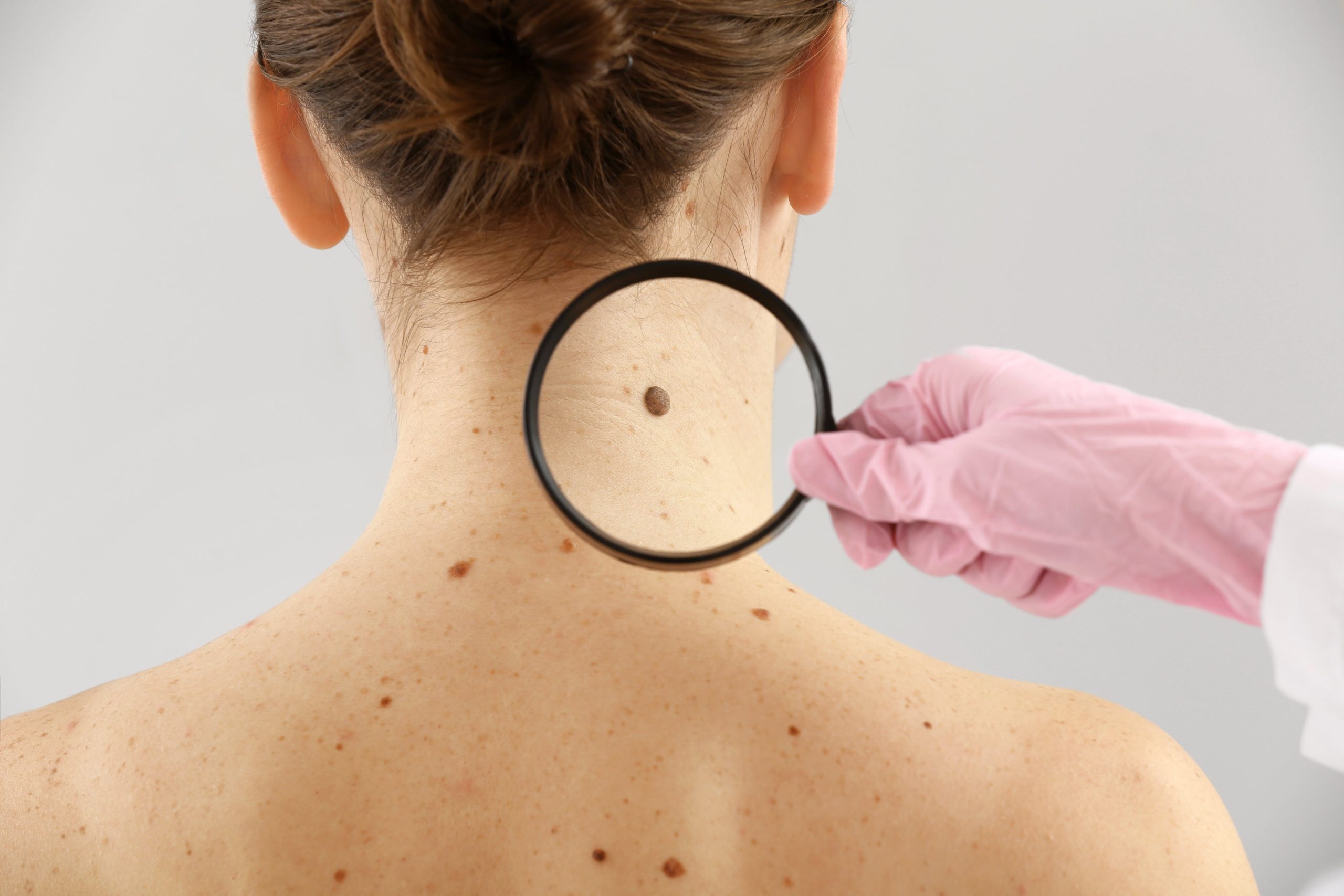 Skin Cancer Screening | Full-Body Skin Cancer Check