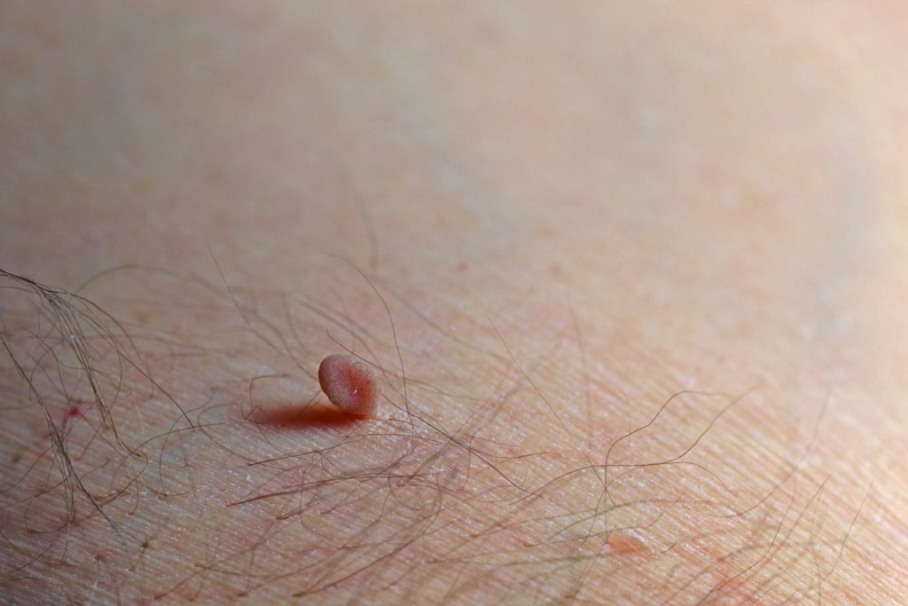 Skin Tag Removal | Schweiger Dermatology Group
