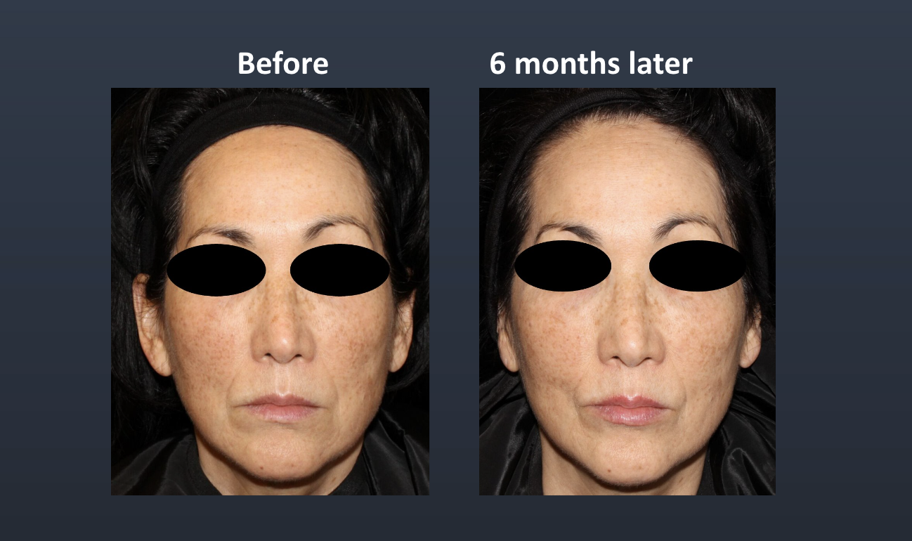 Exosomes vs. PRP: The Future of Skin Rejuvenation Treatments