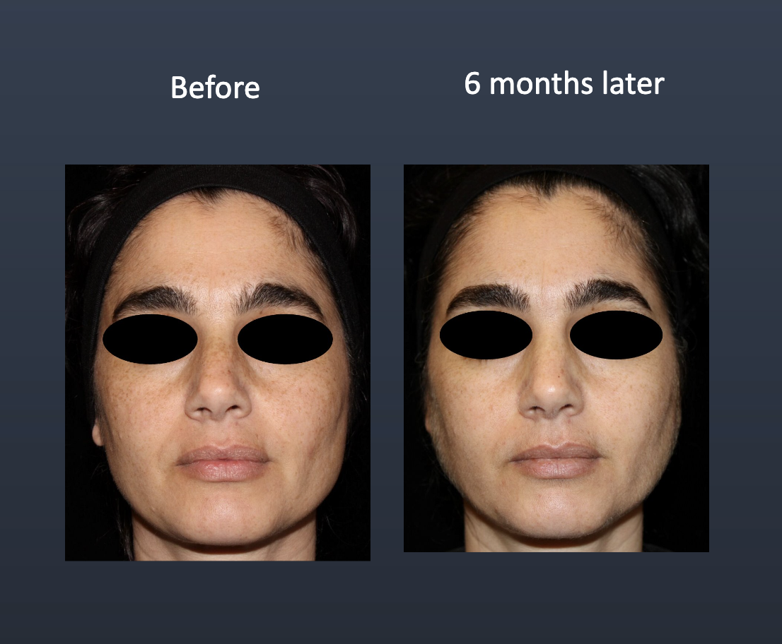 Exosomes vs. PRP: The Future of Skin Rejuvenation Treatments