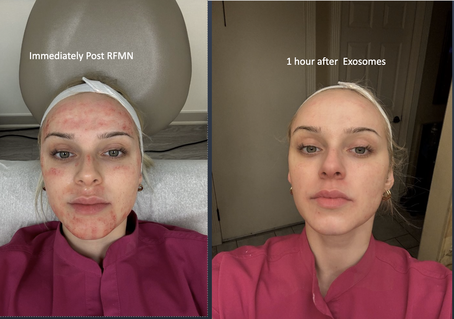 Exosomes vs. PRP: The Future of Skin Rejuvenation Treatments