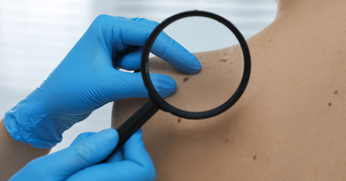 How is Skin Cancer Diagnosed? | Skin Biopsy