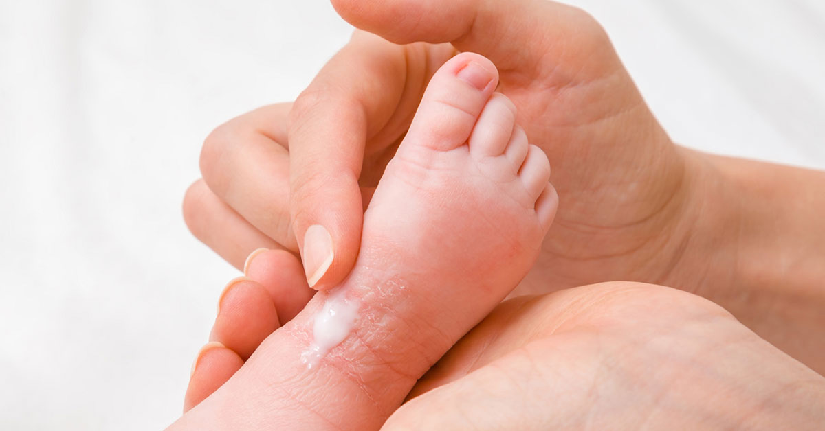 Common Baby Rashes | Understanding Pediatric Rashes