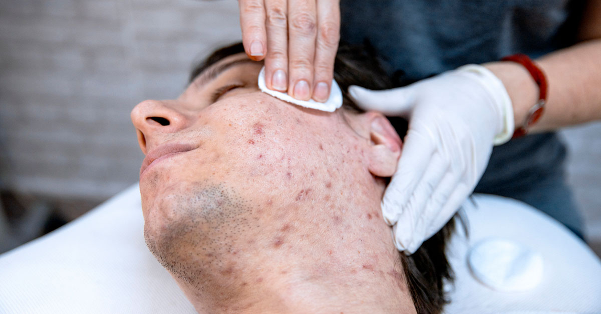 Best Acne Treatments for Men: Expert Solutions for Clear Skin