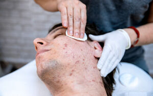 Best Acne Treatments for Men: Expert Solutions for Clear Skin