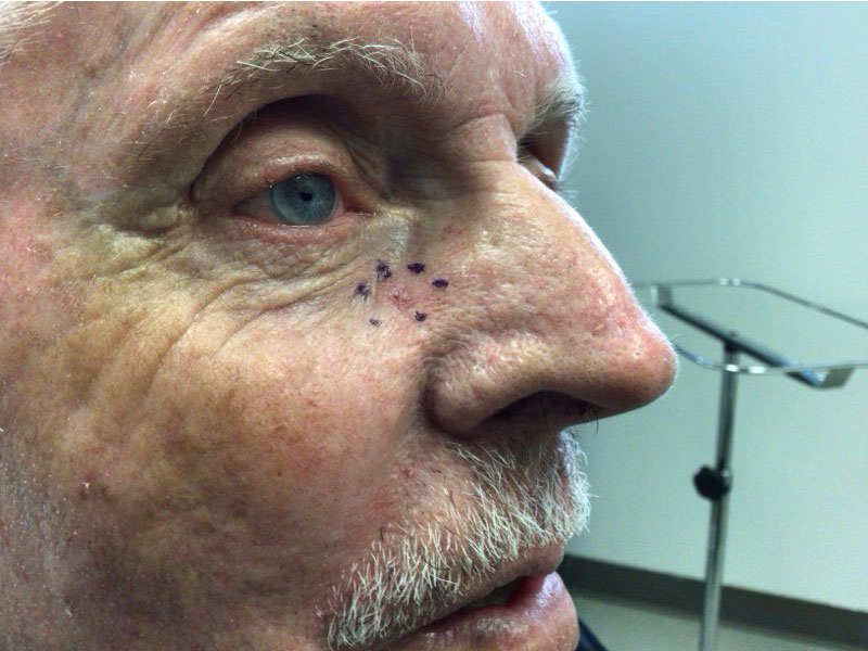 Mohs Surgery Procedure Explained