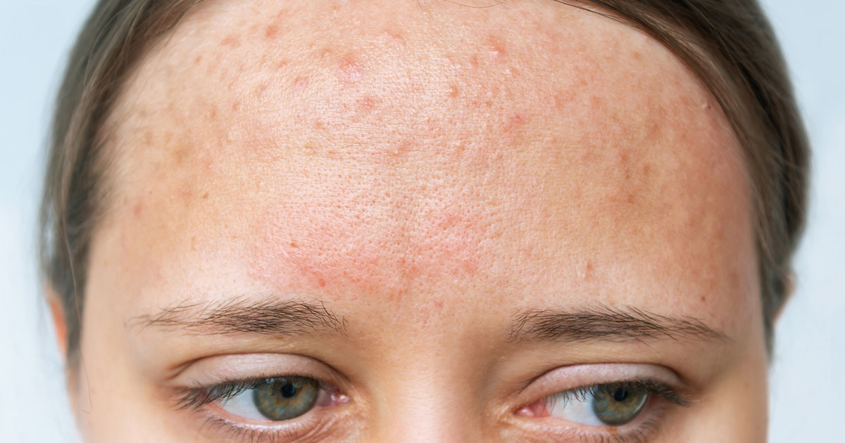 Fungal Acne: Causes, Symptoms, and Effective Treatments