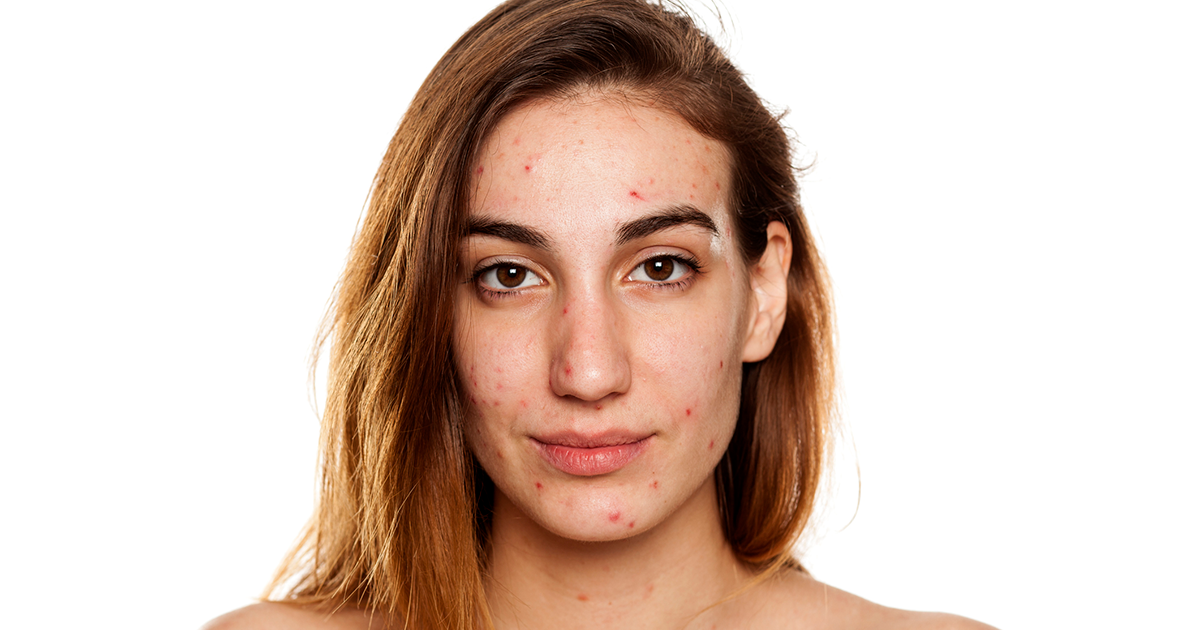 Understanding Different Types of Acne on Your Face