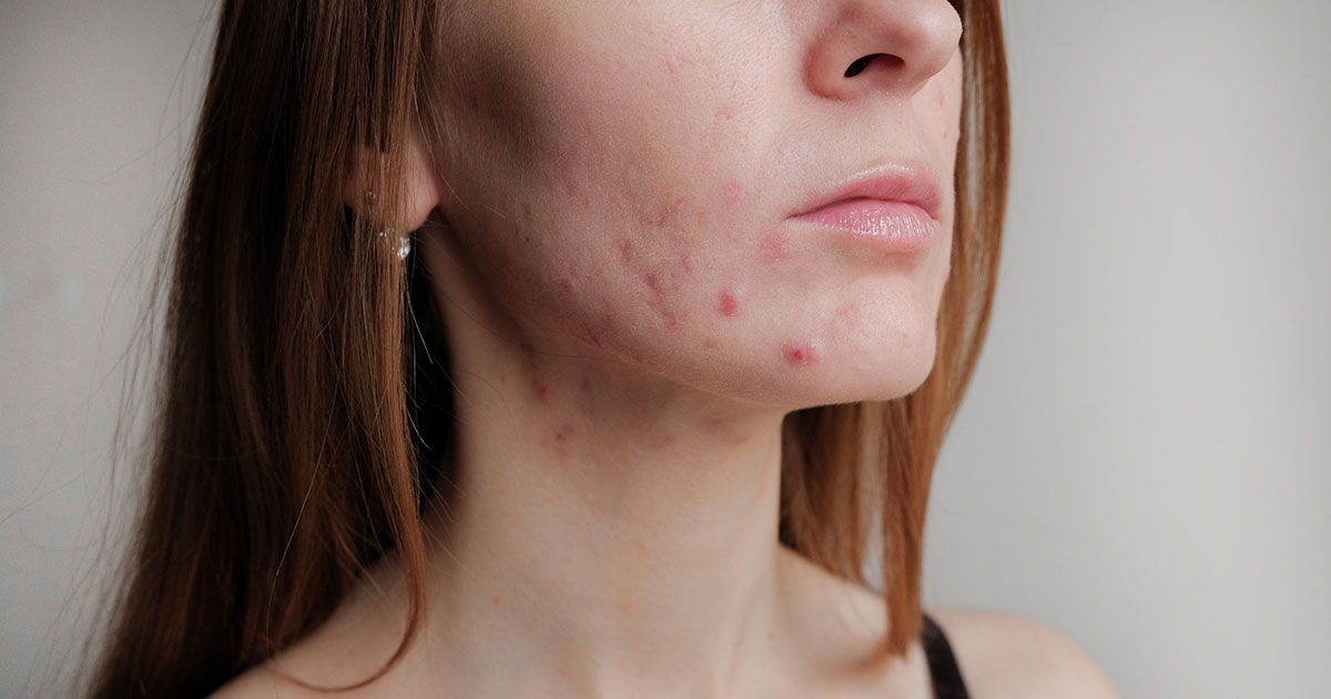 Hormonal Acne vs. Regular Acne: How to Tell the Difference