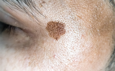 Actinic Keratosis Treatment | Treatments For Solar Keratoses