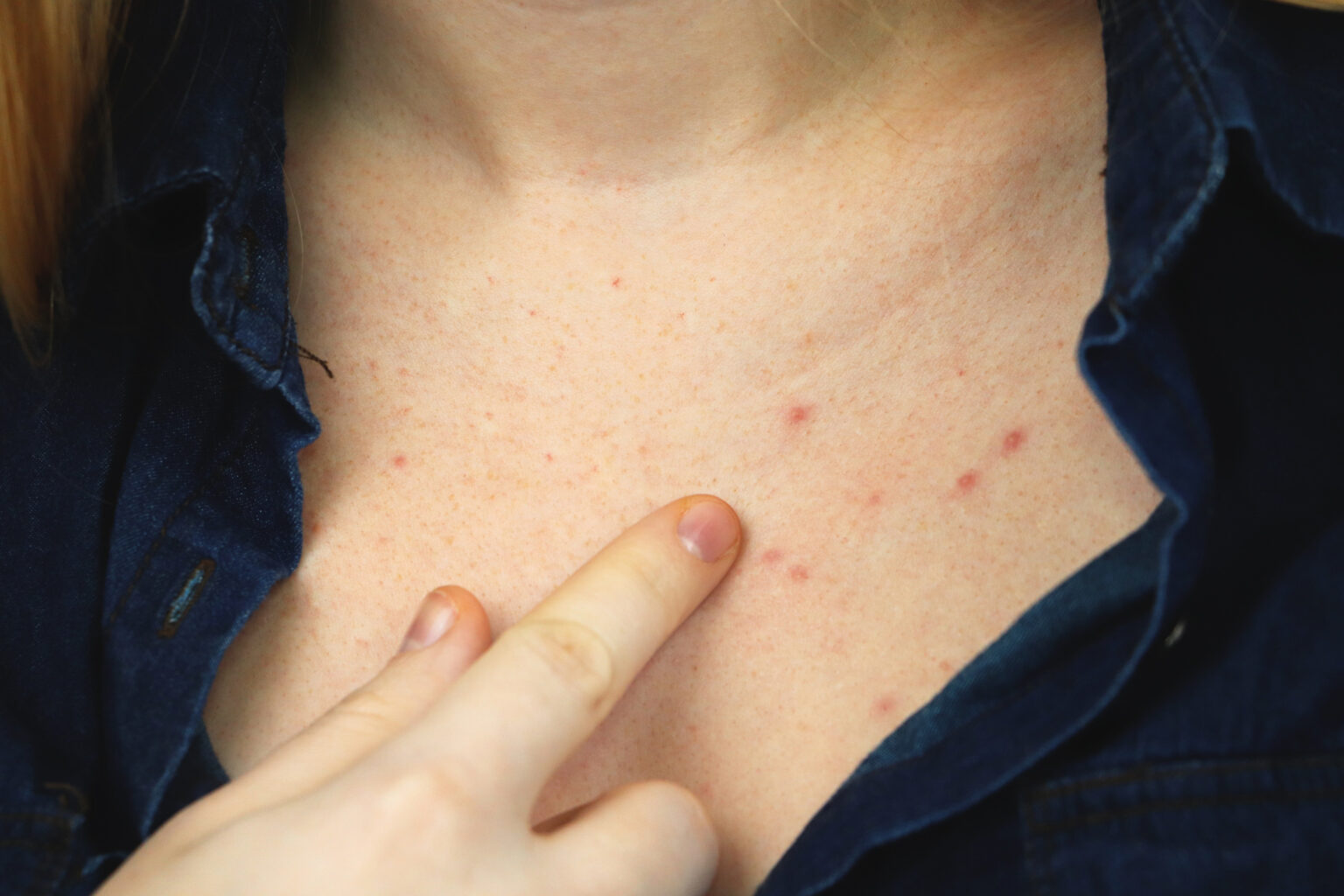 Chest Acne: Causes and Treatments That Actually Work
