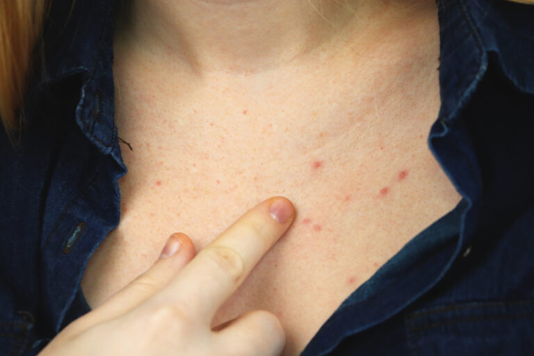 Chest Acne: Causes and Treatments That Actually Work