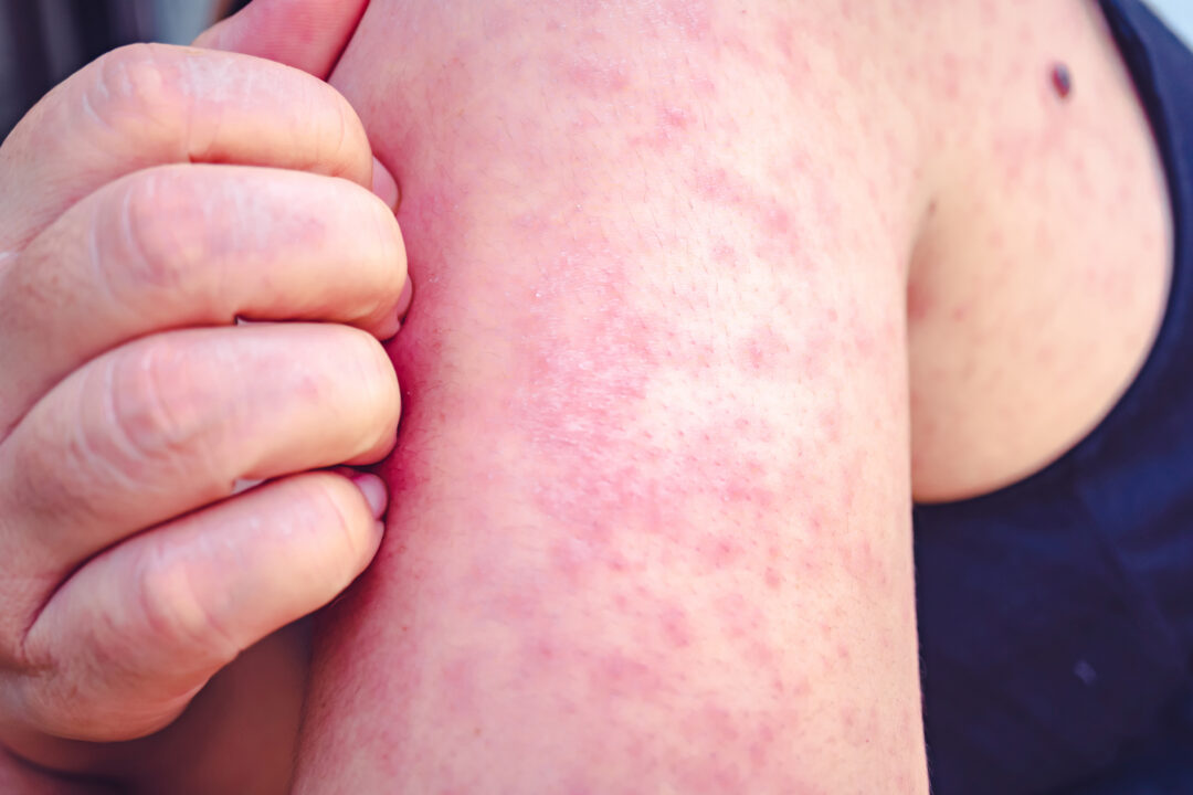 Psoriasis Flare-Up Triggers: What to Watch Out For