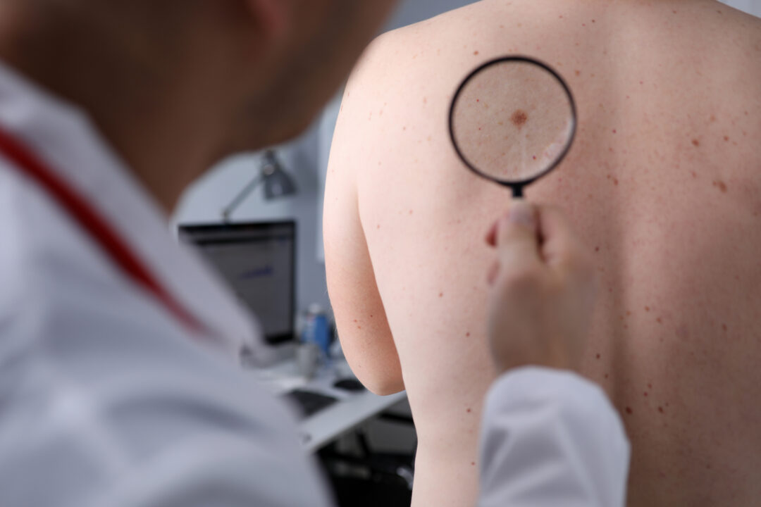 Skin Biopsy for Cancer: Procedure, Healing and Results