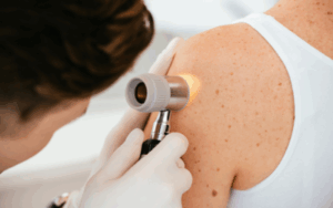 What Happens During a Skin Biopsy for Skin Cancer?