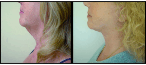 A Reason to Be Thankful: Turkey Neck Treatments that Work | Schweiger ...