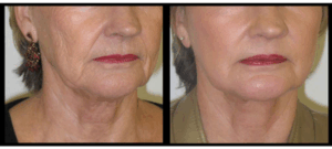 A Reason to Be Thankful: Turkey Neck Treatments that Work | Schweiger ...