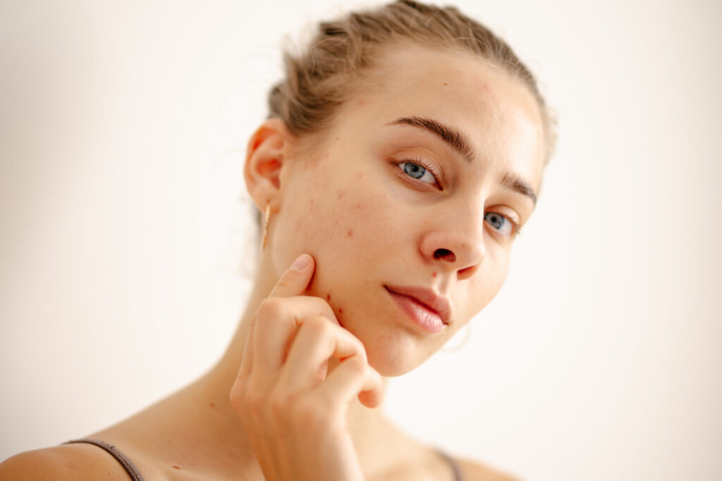 How to Prevent Acne Before Your Period and Reduce Breakouts