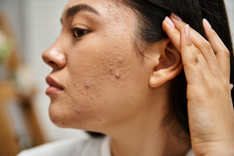 Nodular Acne: Causes, Symptoms, and Treatment Options